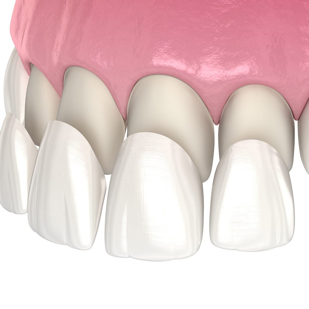 Dental Crowns, Bridges, and Veneers - Star Dental Implants